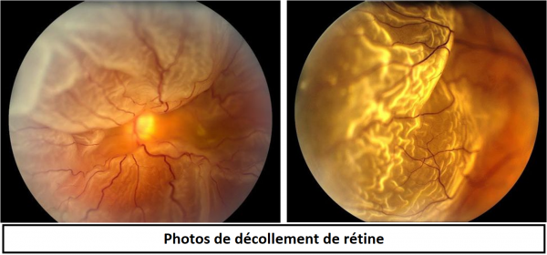 Décollement de rétine - Opération d'urgence