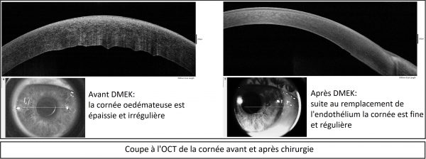 Opération des yeux : greffes de cornée
