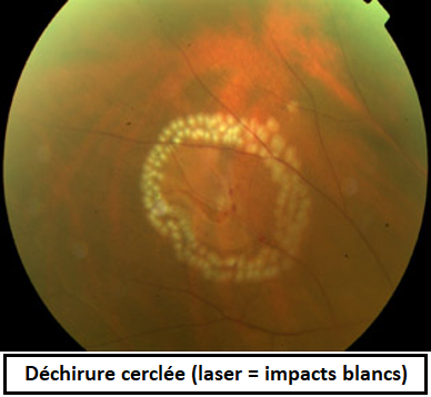 Décollement de rétine - Opération d'urgence